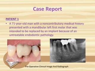 Journal Club On Pre-extractive Interradicular Implant Bed Preparation ...