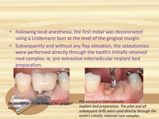 Journal Club On Pre-extractive Interradicular Implant Bed Preparation ...