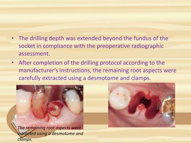 Journal Club On Pre-extractive Interradicular Implant Bed Preparation ...