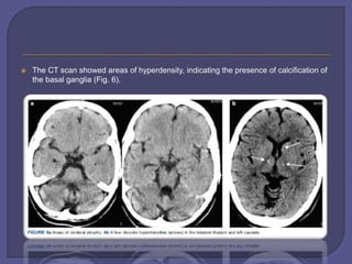 Fahr Syndrome- A Rare Case Report | PPTX