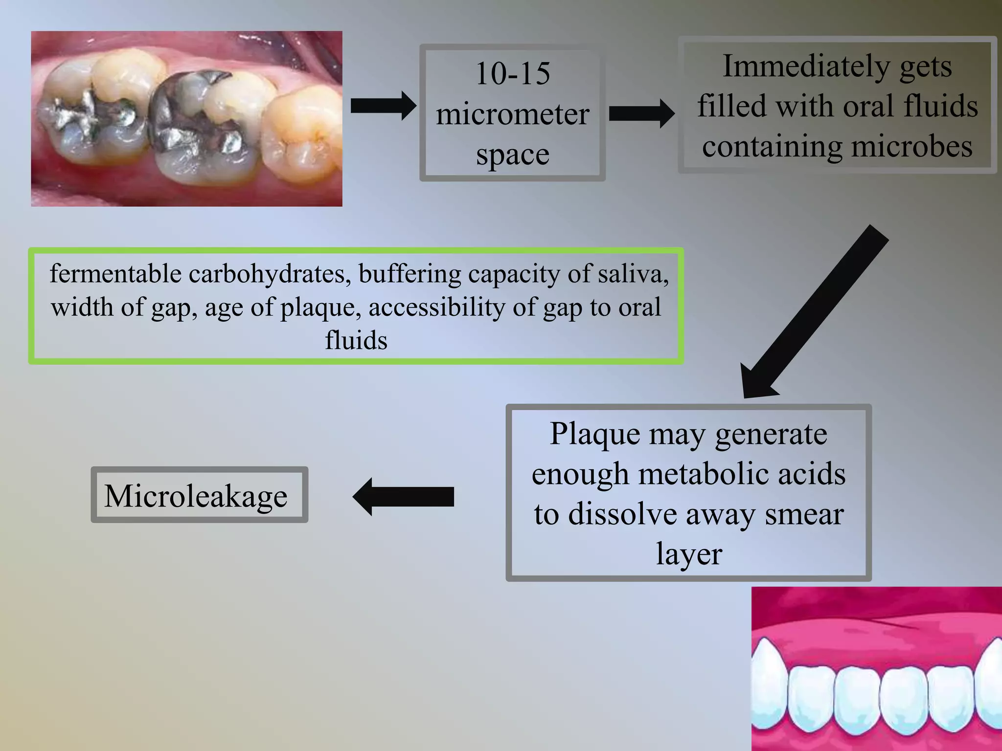 David H Pashley: Clinical considerations of microleakage | PPTX