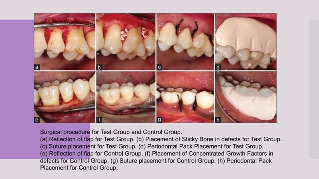 comparison between sticky bone and concentrated growth factor | PPT