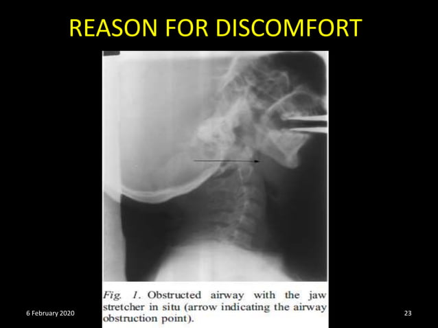 Journal Club New protocol to prevent TMJ reankylosis and potentially ...