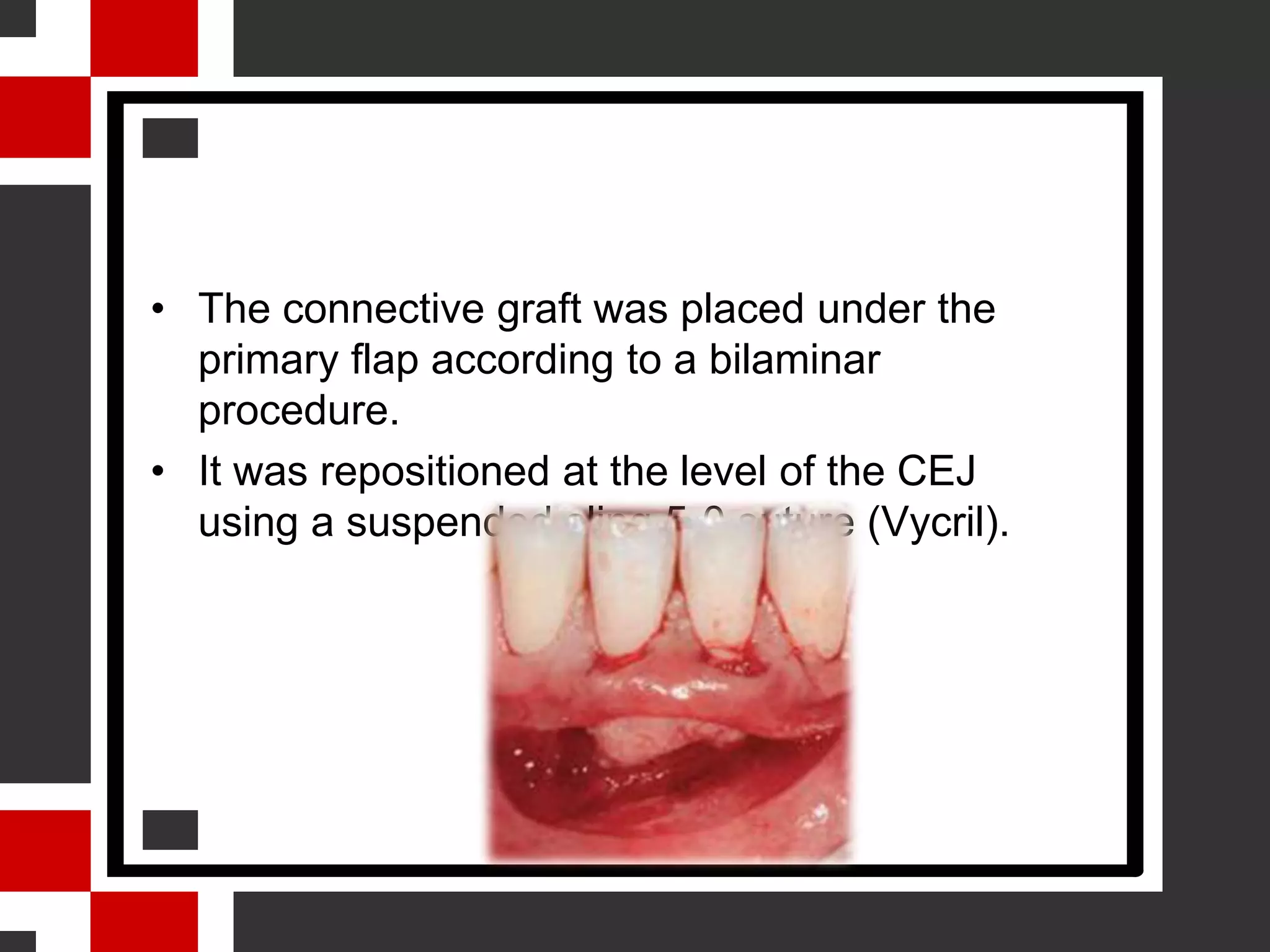 Journal club on A Mucogingival Technique for the Treatment of Multiple ...