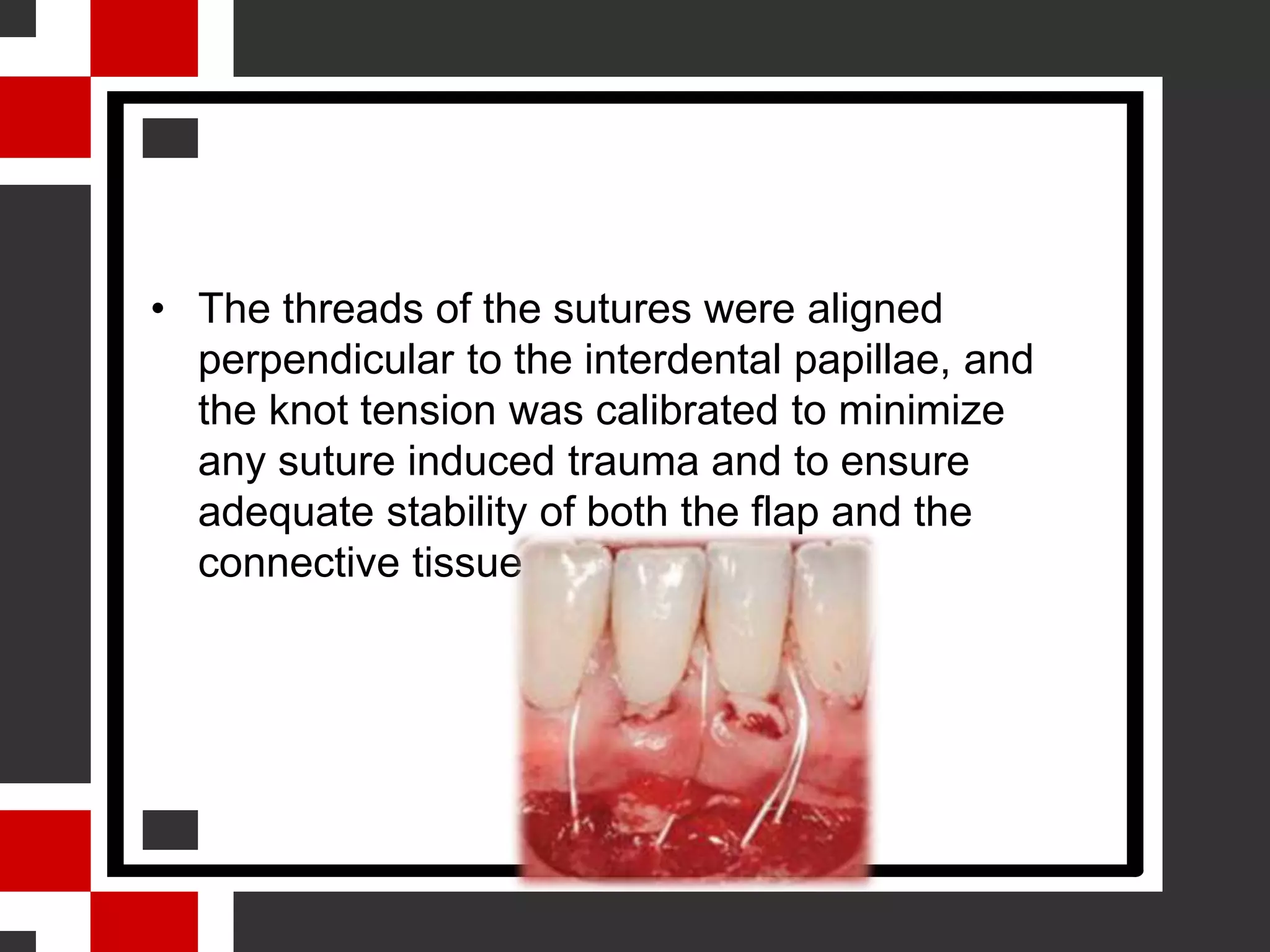 Journal club on A Mucogingival Technique for the Treatment of Multiple ...