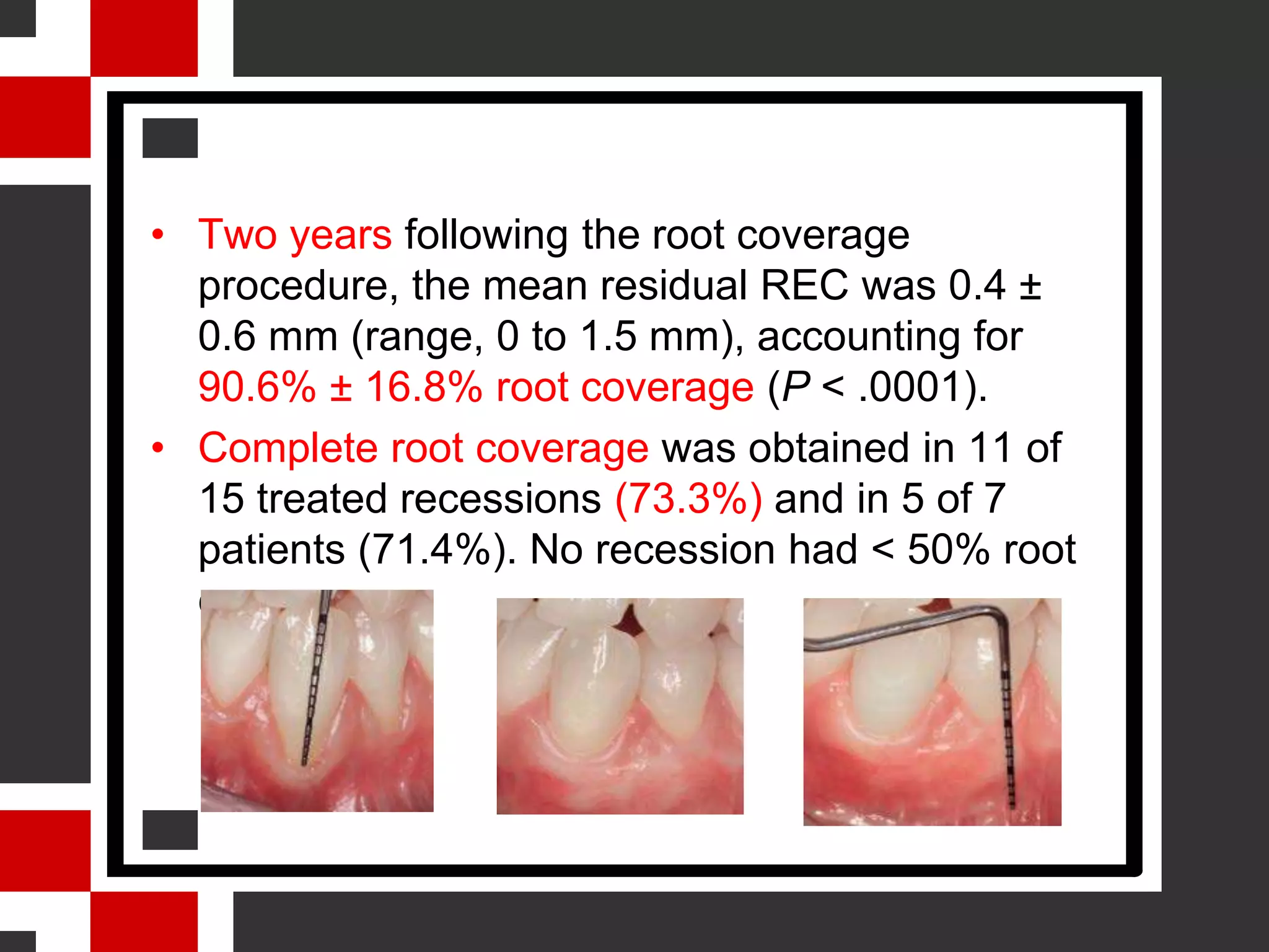 Journal club on A Mucogingival Technique for the Treatment of Multiple ...