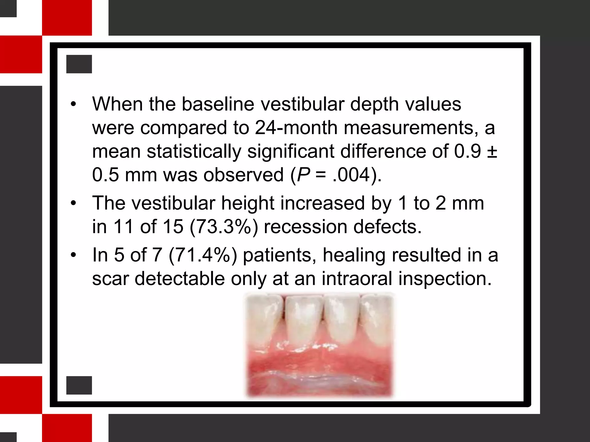 Journal club on A Mucogingival Technique for the Treatment of Multiple ...