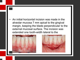 Journal club on A Mucogingival Technique for the Treatment of Multiple ...