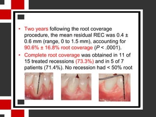 Journal club on A Mucogingival Technique for the Treatment of Multiple ...