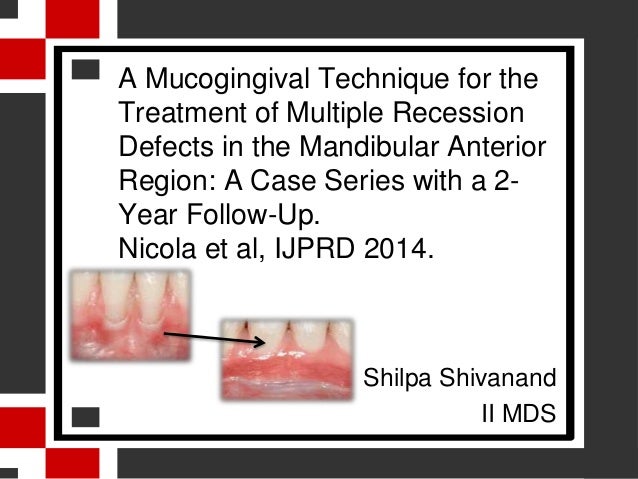 Journal club on A Mucogingival Technique for the Treatment of Multipl…