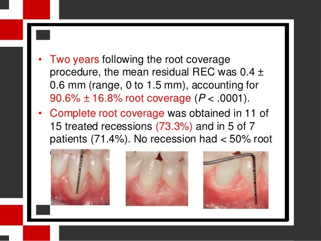 Journal club on A Mucogingival Technique for the Treatment of Multipl…