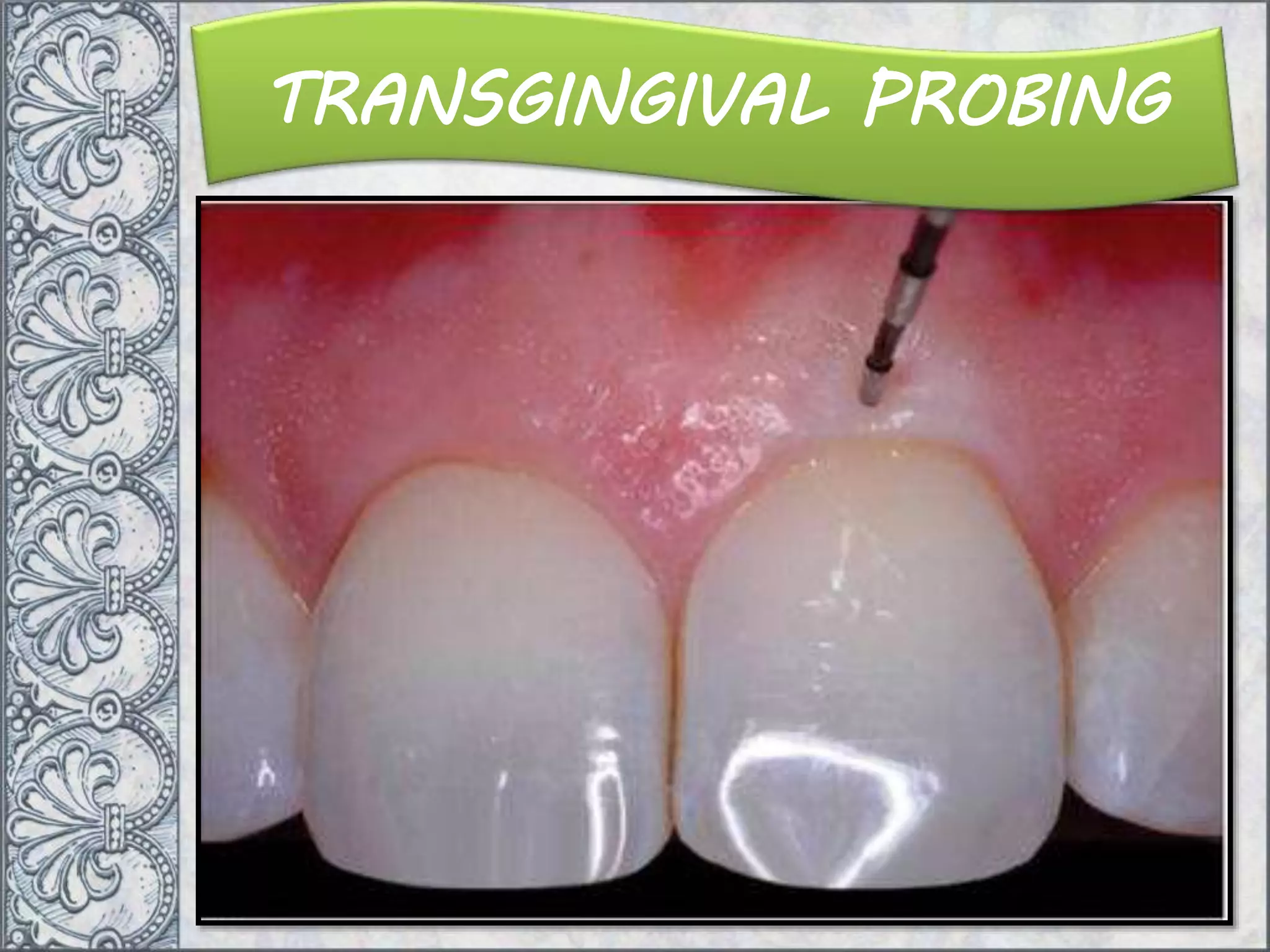 horizontal stability of connective tissue graft: journal club on ...