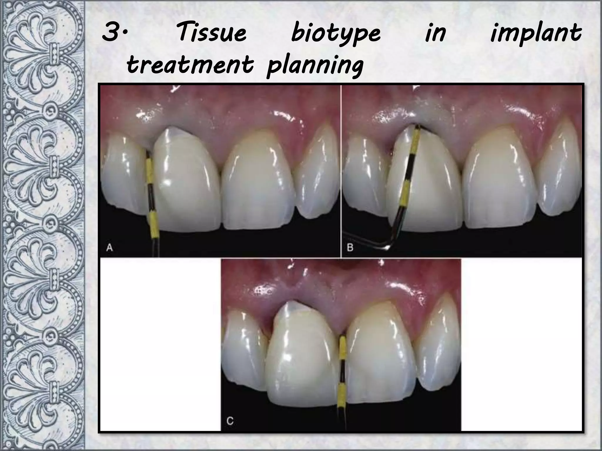 horizontal stability of connective tissue graft: journal club on ...