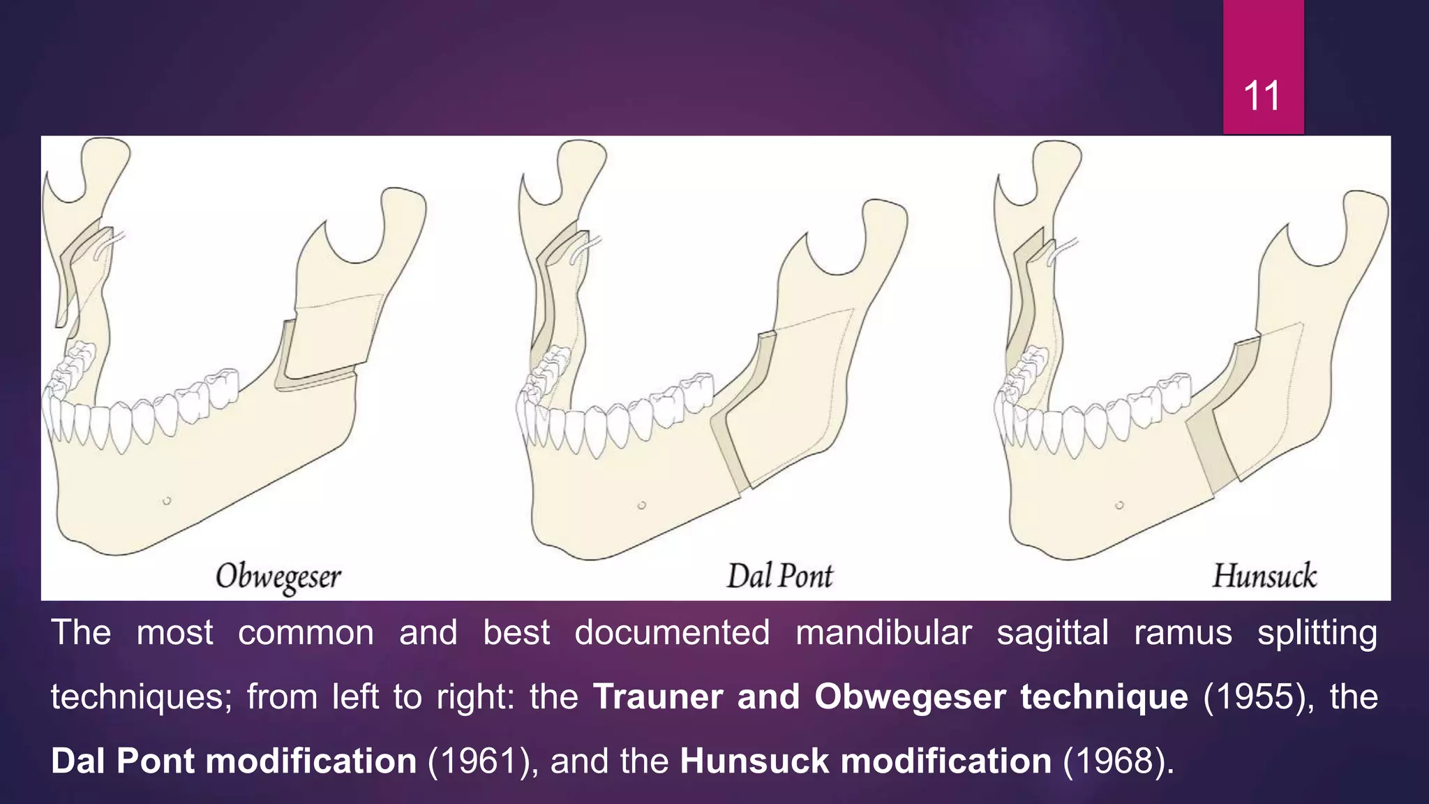 Journal Club Bad splits in bilateral sagittal split osteotomy ...