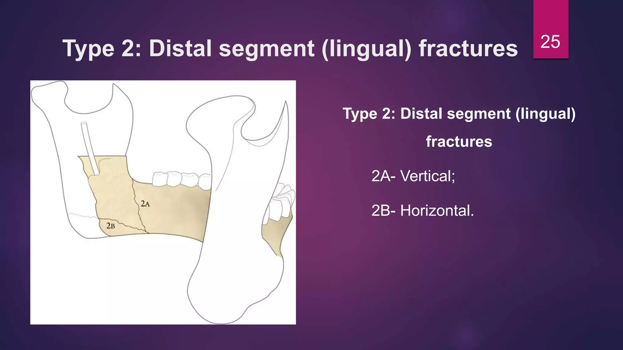 Journal Club Bad splits in bilateral sagittal split osteotomy ...