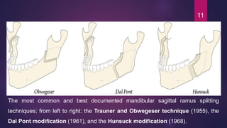 Journal Club Bad splits in bilateral sagittal split osteotomy ...