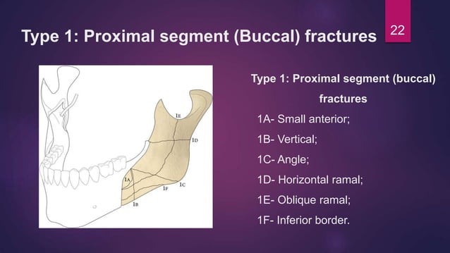 Journal Club Bad splits in bilateral sagittal split osteotomy ...