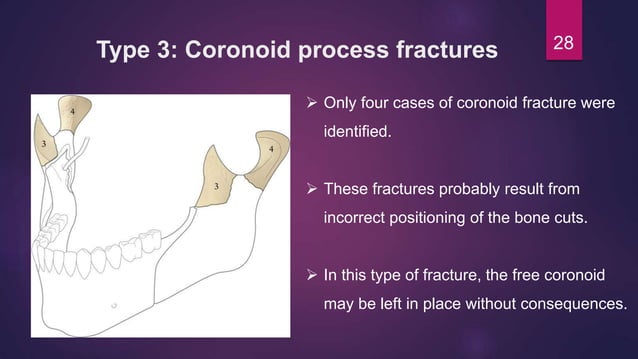 Journal Club Bad splits in bilateral sagittal split osteotomy ...