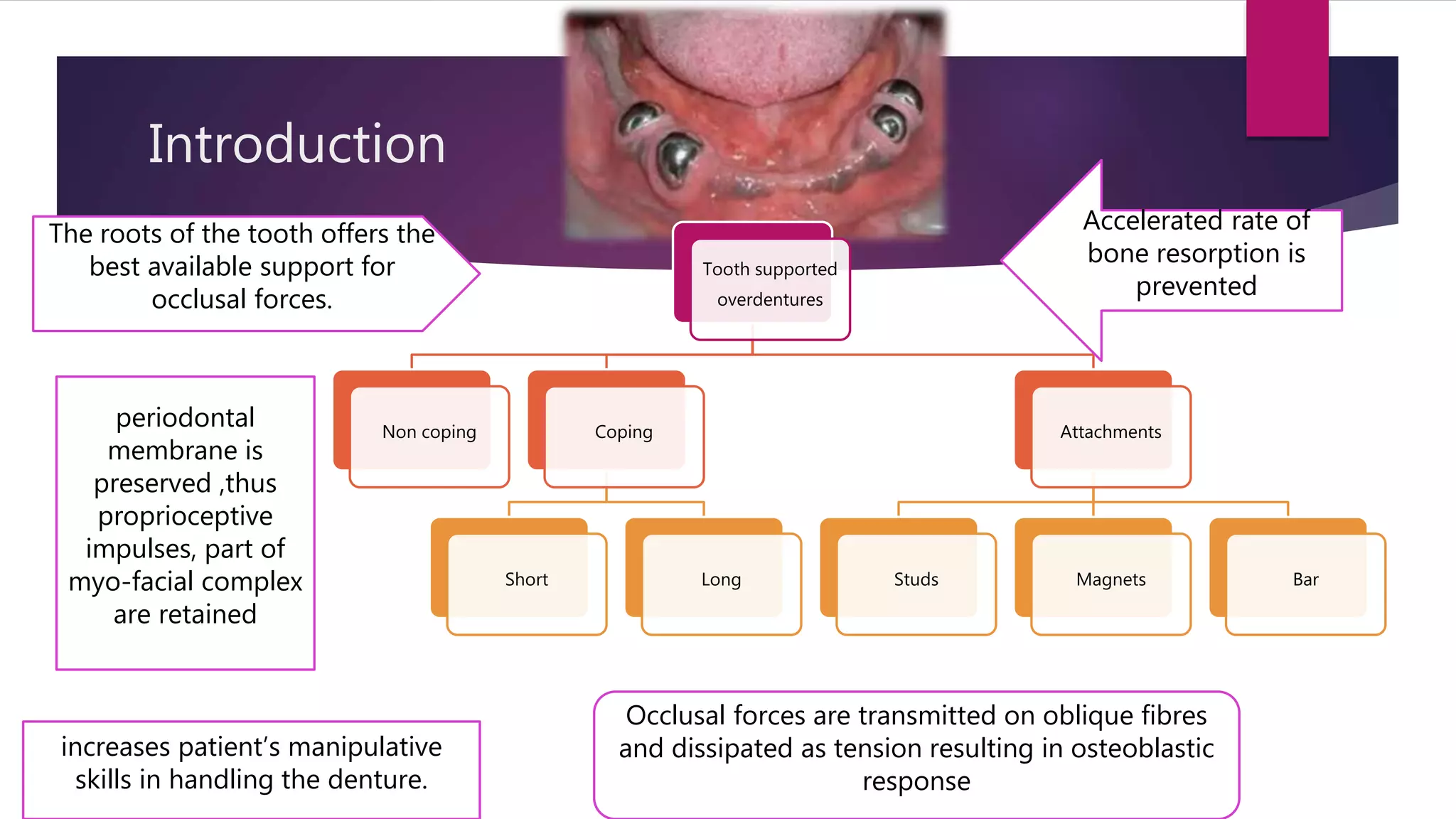 Journal club presentation on tooth supported overdentures | PPTX