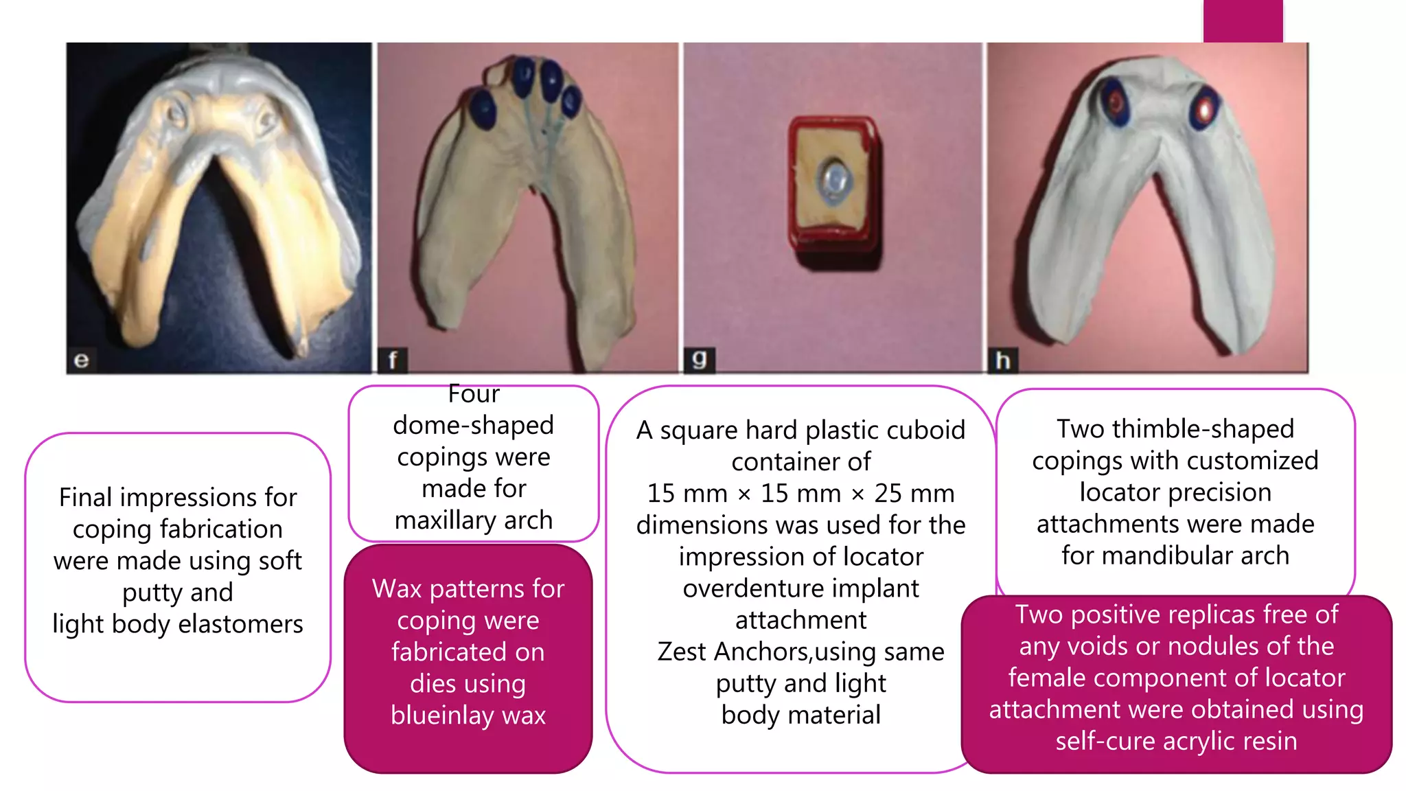 Journal club presentation on tooth supported overdentures | PPTX