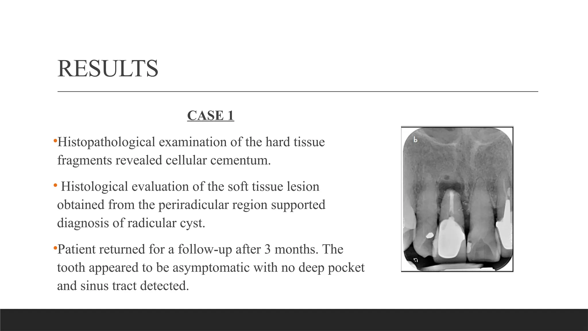 cemental tear on maxillary anterior incisors a description of clinical ...