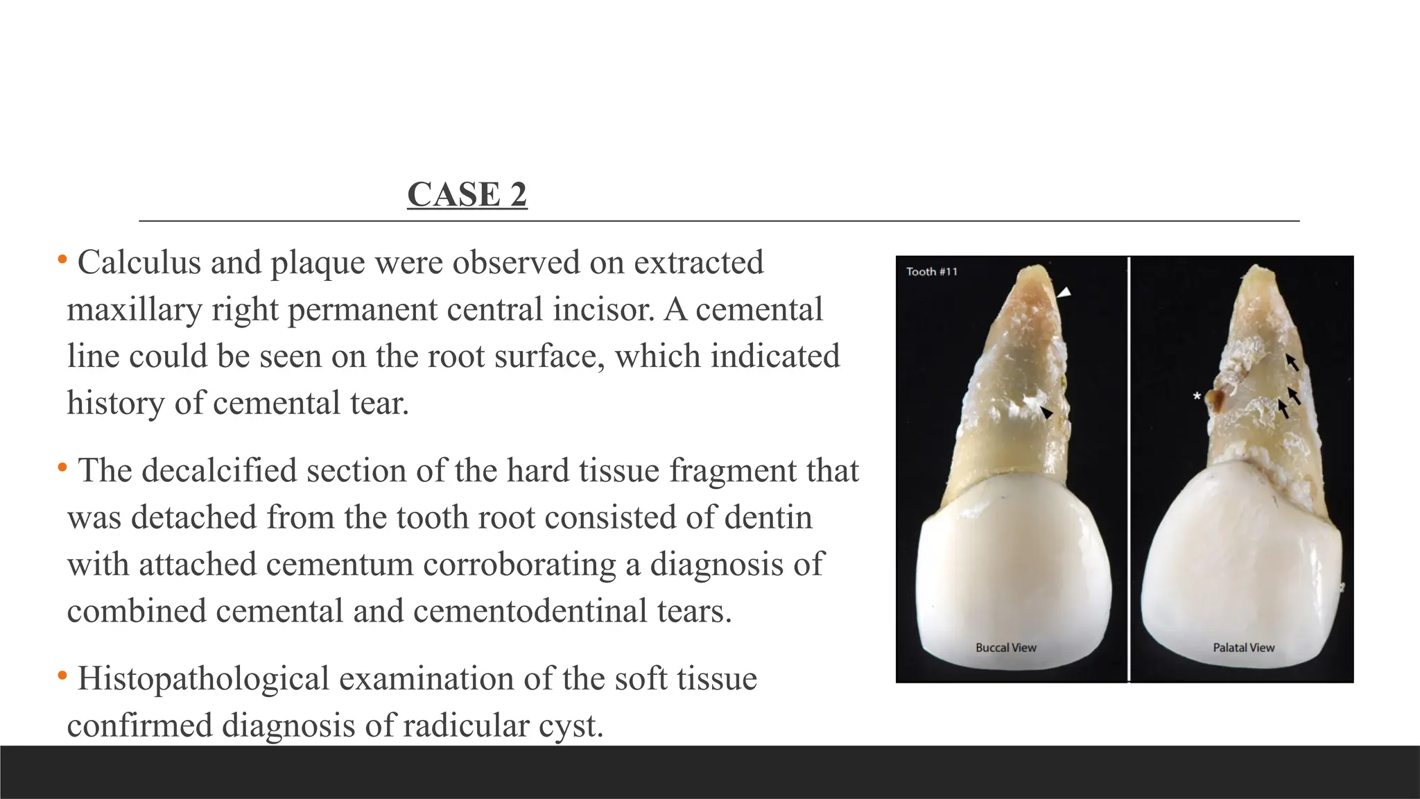 cemental tear on maxillary anterior incisors a description of clinical ...