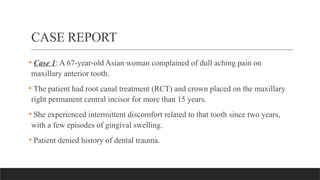 cemental tear on maxillary anterior incisors a description of clinical ...