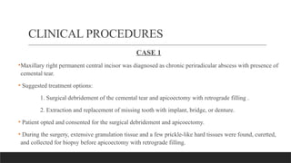 cemental tear on maxillary anterior incisors a description of clinical ...