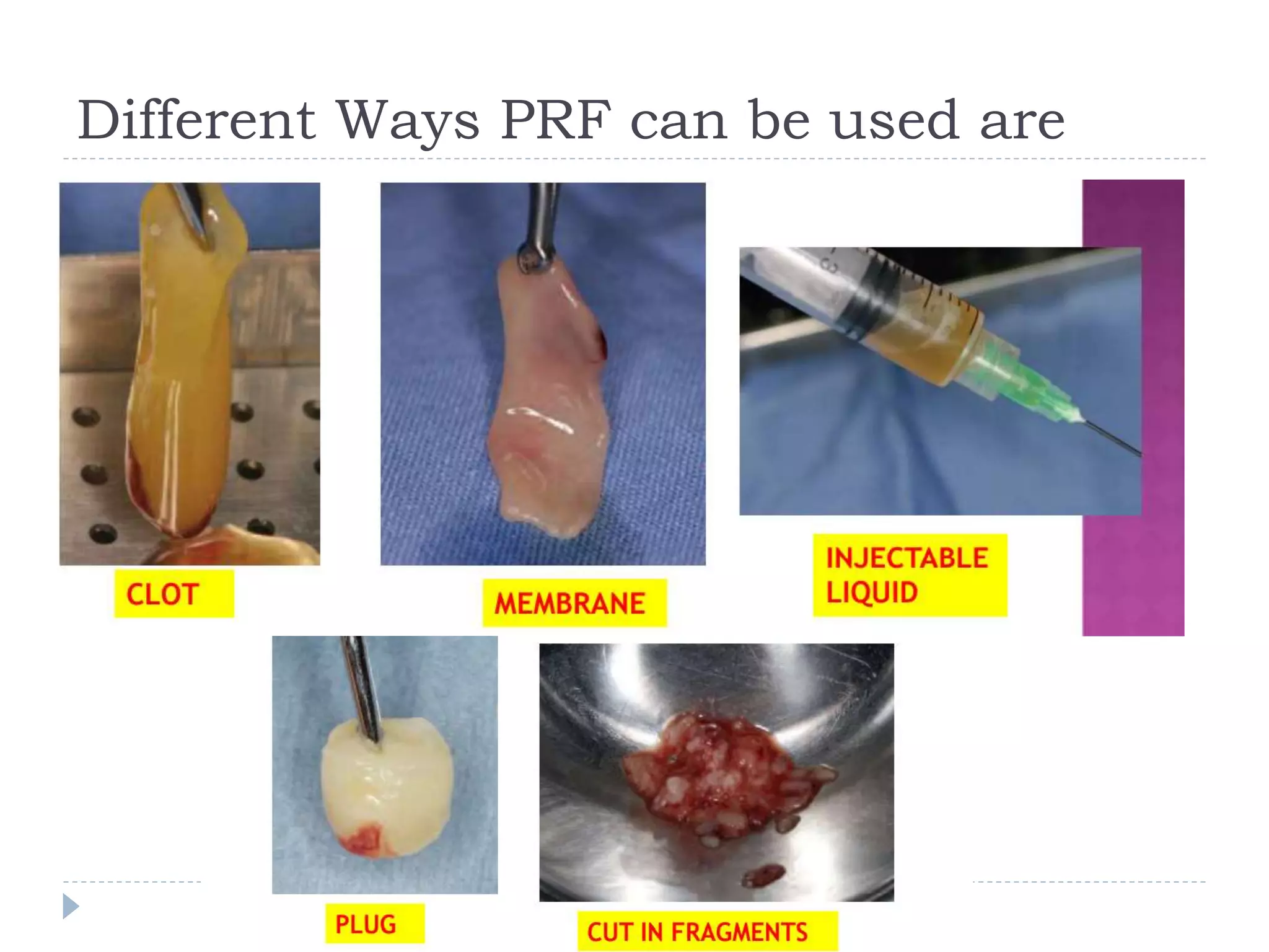 Introduction to Platelet Rich Fibrin (PRF) and its uses in Dentistry | PPTX