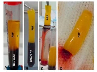 Introduction to Platelet Rich Fibrin (PRF) and its uses in Dentistry | PPTX