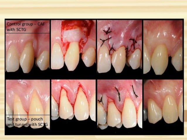 JOURNAL CLUB ON CORONALLY ADVANCED FLAP vs THE POUCH TECHNIQUE COMBIN…