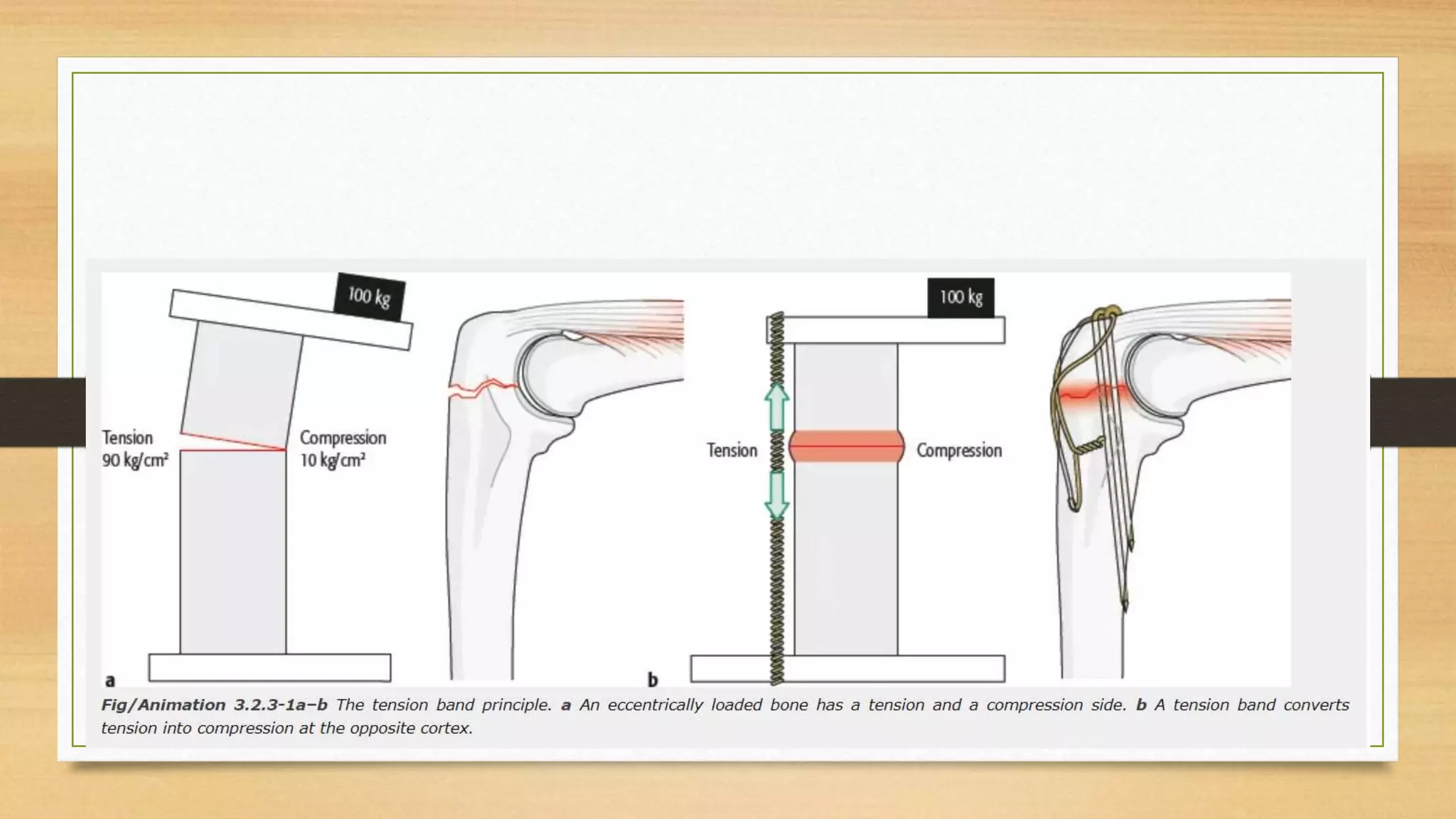 Concepts of Rigid Fixation in Facial Fractures | PPT