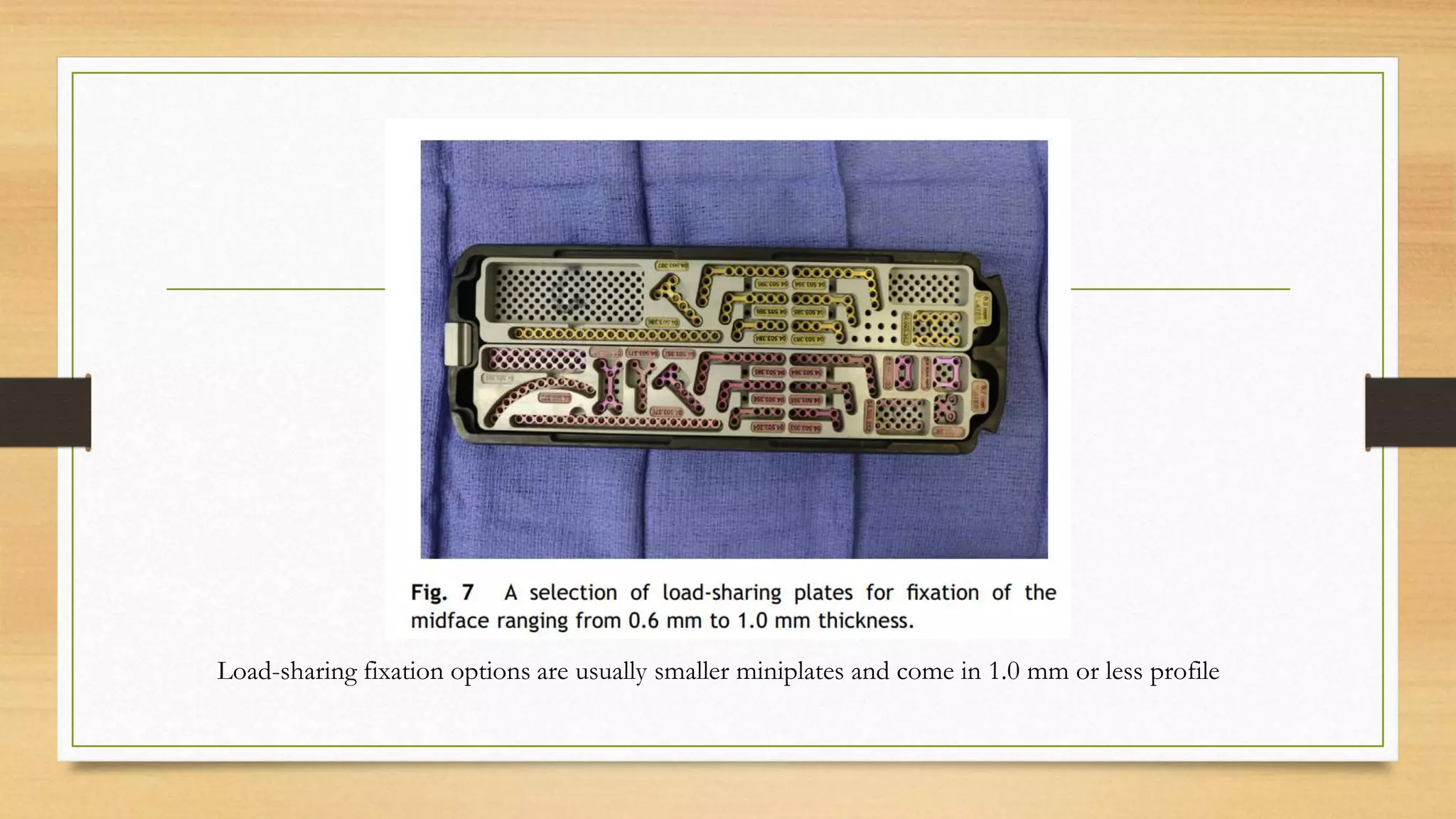Concepts of Rigid Fixation in Facial Fractures | PPT