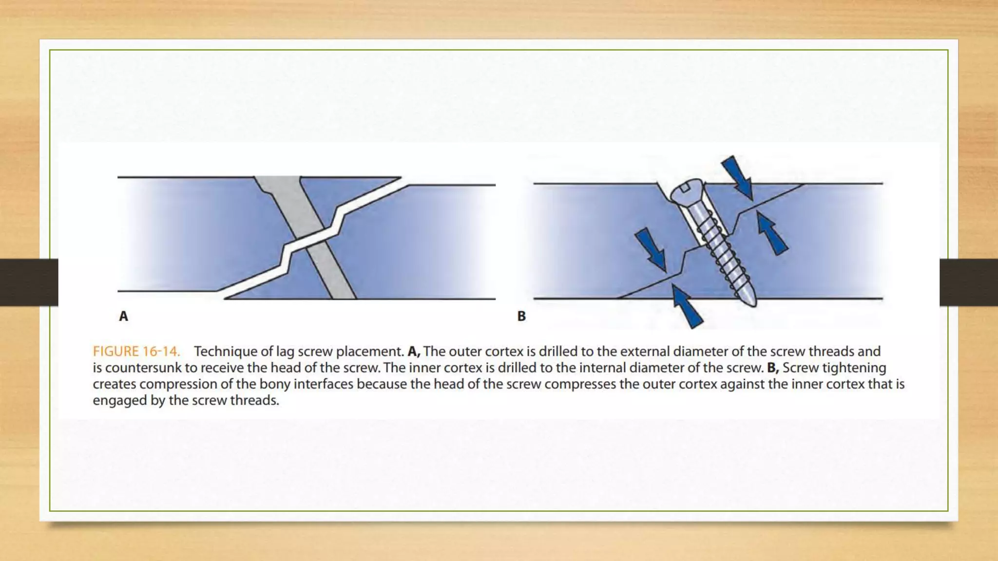 Concepts of Rigid Fixation in Facial Fractures | PPT