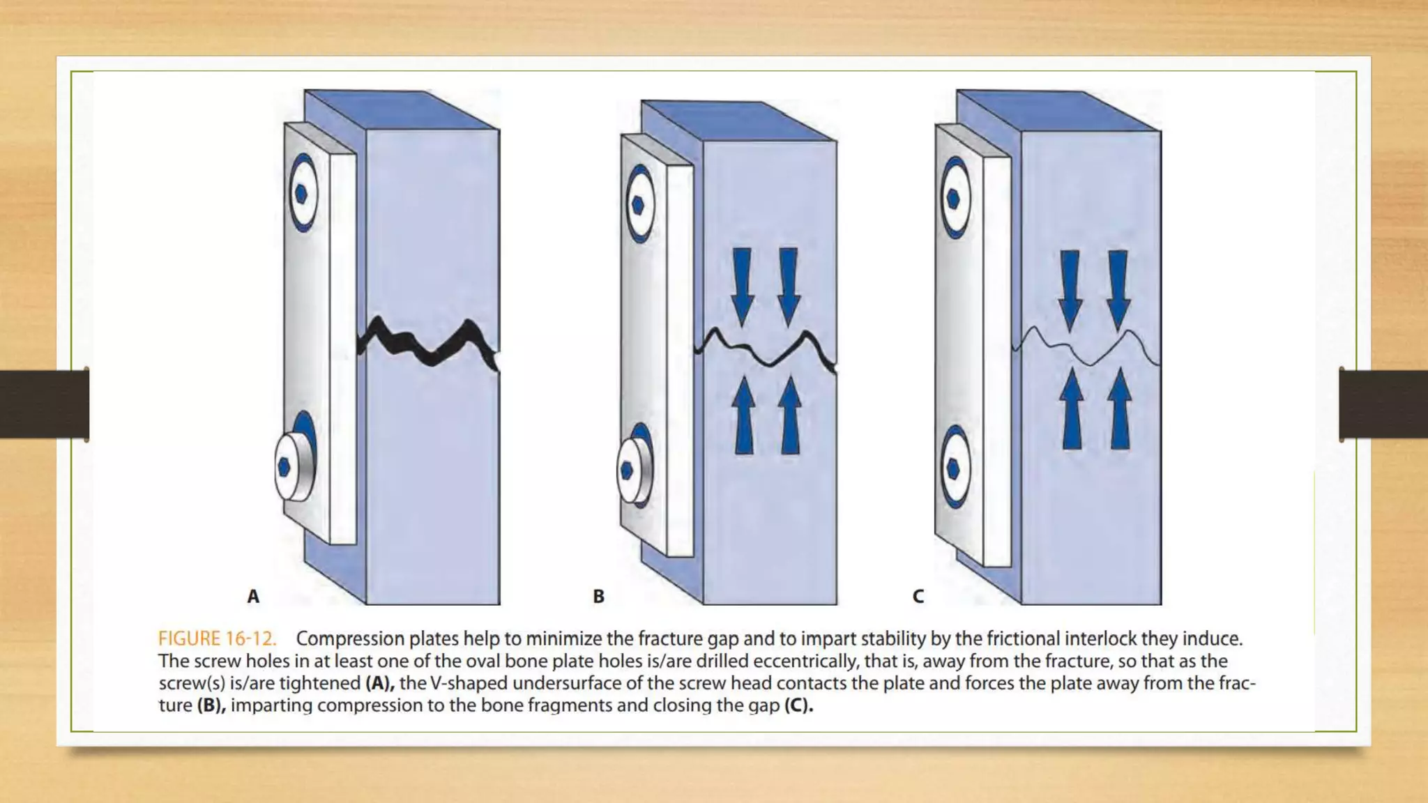 Concepts of Rigid Fixation in Facial Fractures | PPT