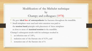 Concepts of Rigid Fixation in Facial Fractures | PPT