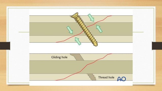Concepts of Rigid Fixation in Facial Fractures
