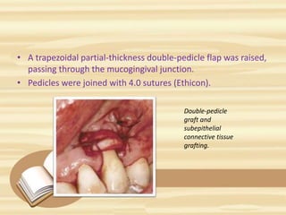 journal club on Progressive Root Resorption Associated with the ...
