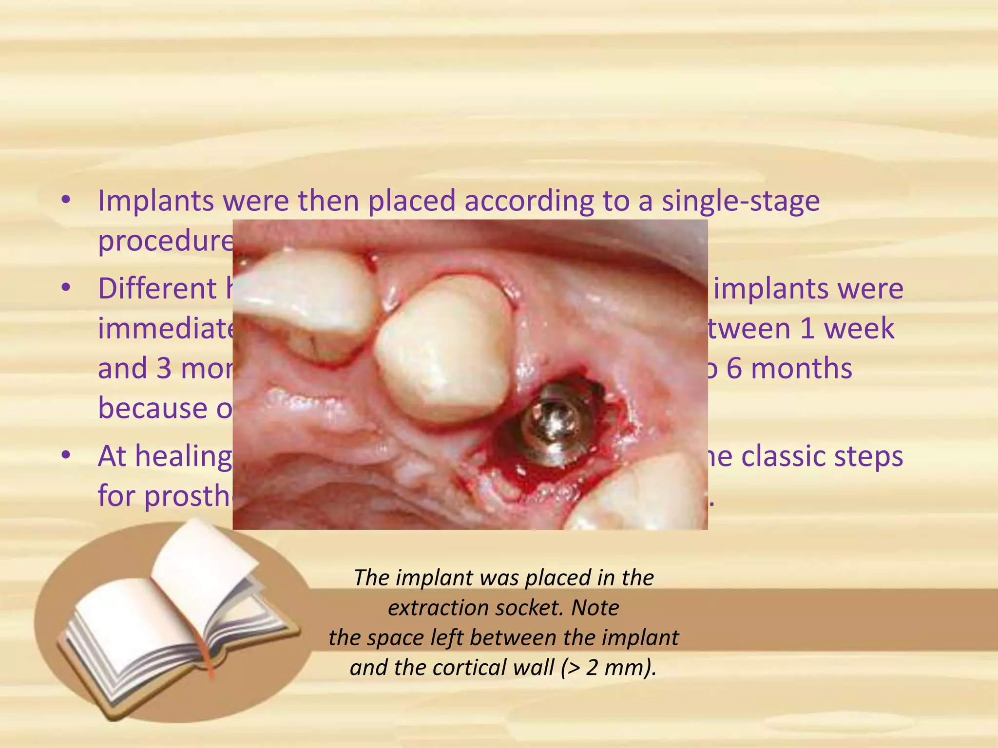 Atraumatic Tooth Extraction and Immediate Implant Placement with Piezosurgery: Evaluation of 40 ...