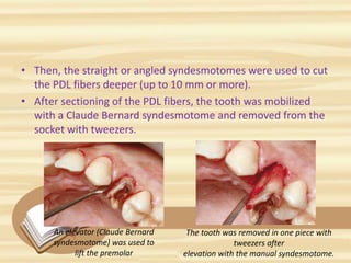 Atraumatic Tooth Extraction and Immediate Implant Placement with ...