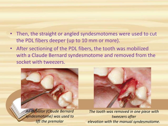 Atraumatic Tooth Extraction and Immediate Implant Placement with ...
