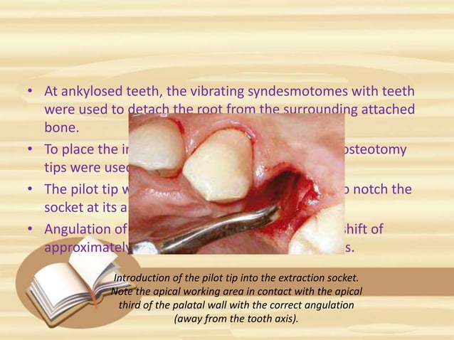 Atraumatic Tooth Extraction and Immediate Implant Placement with ...