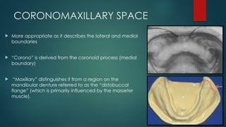 Journal club on coronomaxillary seal or distobuccal space in maxilla | PPTX
