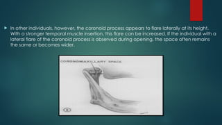 Journal club on coronomaxillary seal or distobuccal space in maxilla | PPTX