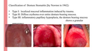 PHOTODYNAMIC THEREPY FOR DENTURE STOMATITIS | PPTX