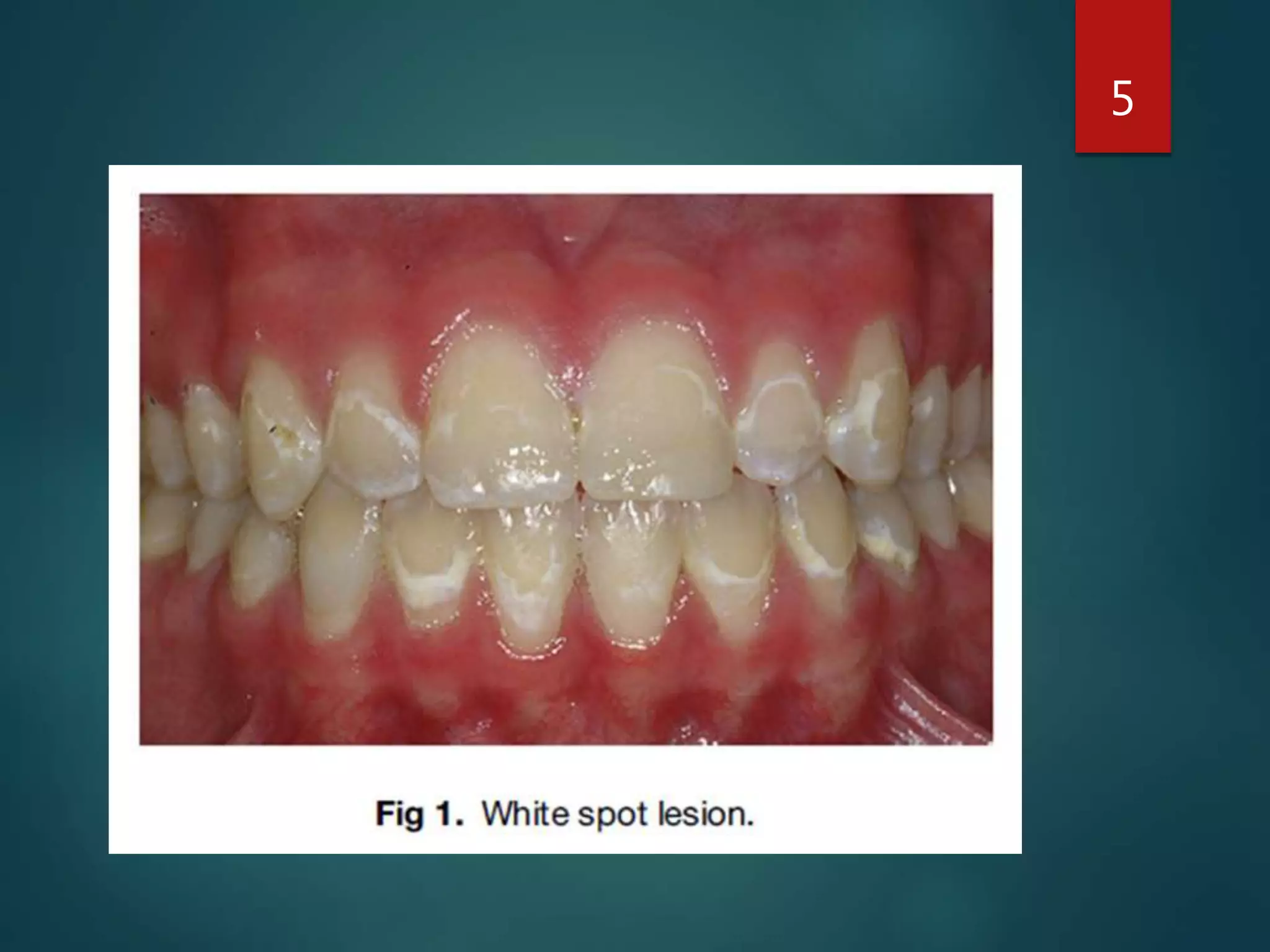White Spot Lesions: Prevention and Treatment | PPTX