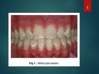 White Spot Lesions: Prevention and Treatment | PPTX