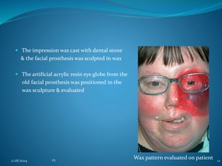 Journal Club presentation for maxillofacial prosthesis | PPTX
