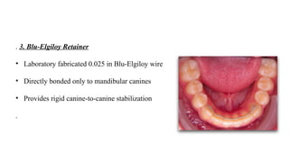 Comparative Study of Mandibular Fixed Retainers: Survival Rates and ...