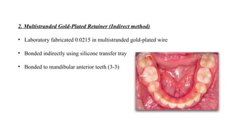 Comparative Study of Mandibular Fixed Retainers: Survival Rates and ...